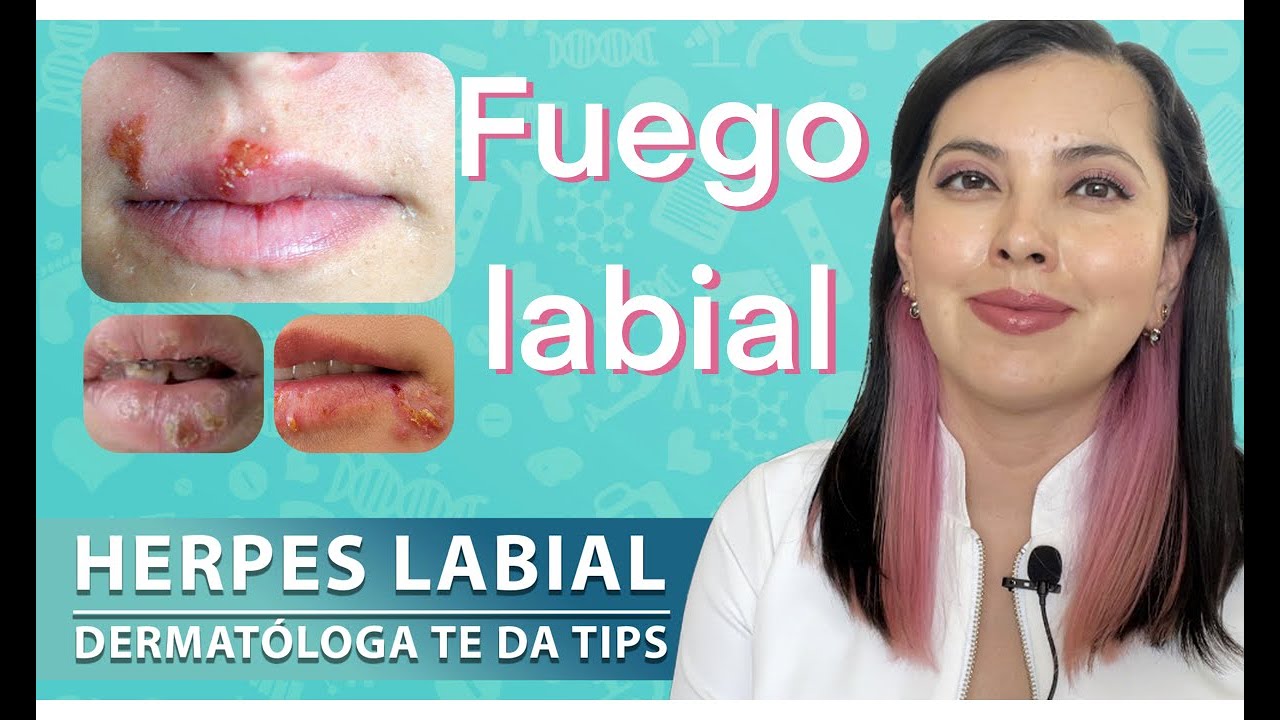 FUEGO LABIAL, datos que debes conocer, Tips de una Dermatóloga 👩🏻‍⚕️ ...