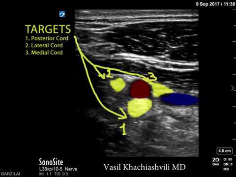 Infraclavicular Brachial Plexus Block - Dr. Vasil Khachiashvili - YouTube
