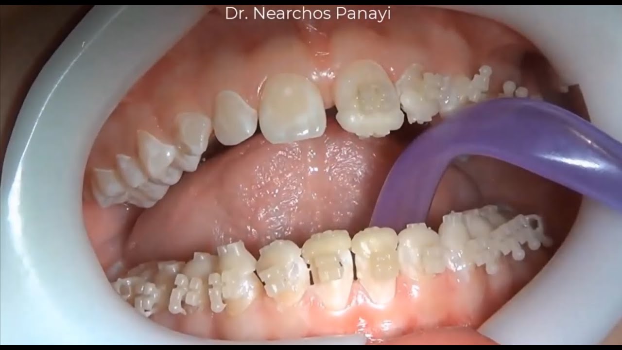 3D printed customised brackets for orthodontics and indirect bonding ...