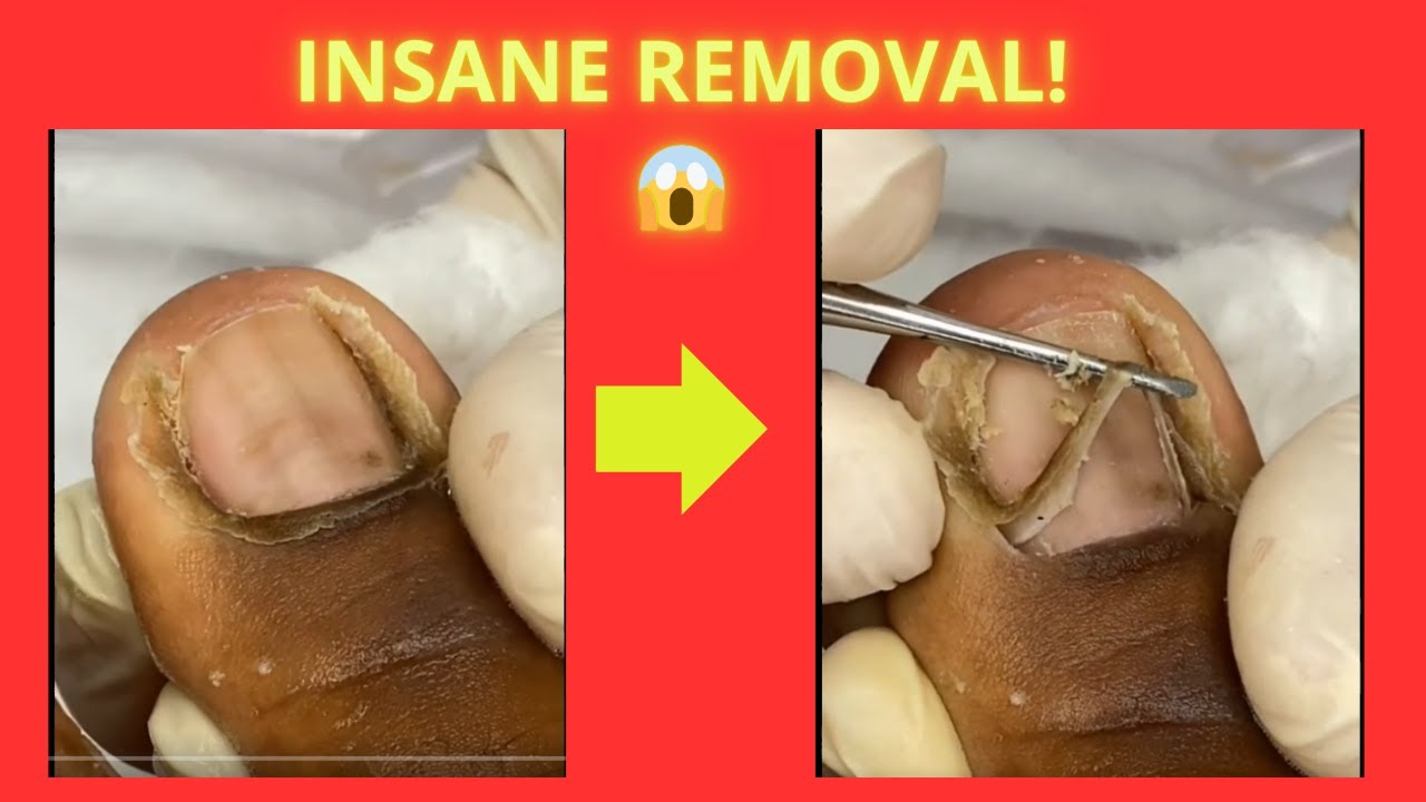 🔥 "Extreme Onychophosis Removal Compilation – Shocking Foot Transformations! 👀" - YouTube