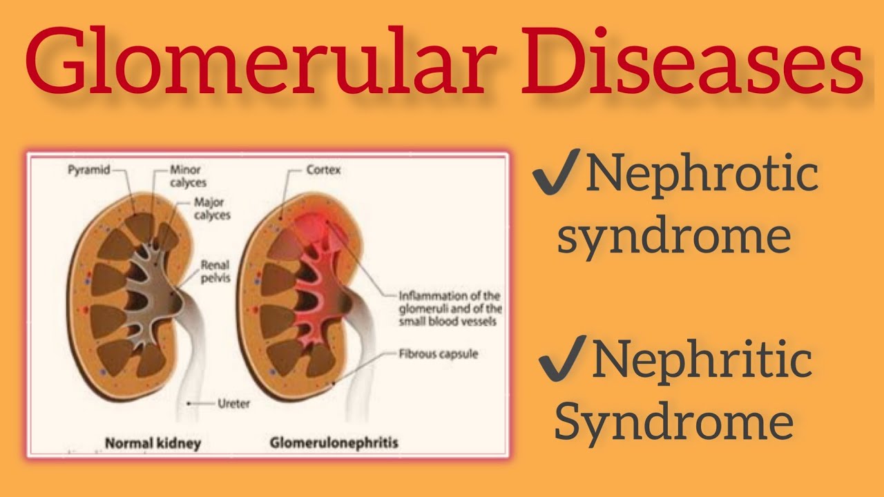 Types of glomerular diseases | Glomerulus | kidney #glomerulonephritis ...