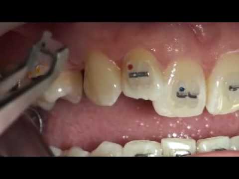 Brace Fitting West London Orthodontist - YouTube