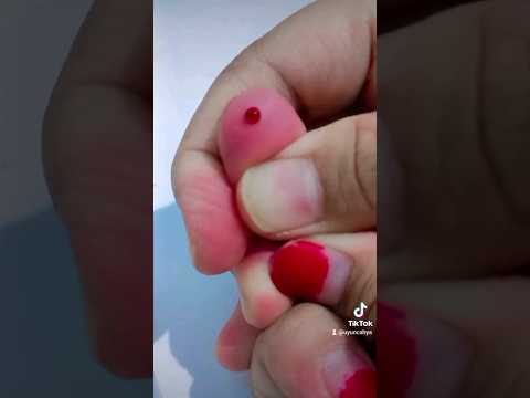 AMBIL DARAH SENDIRI Pemeriksaan DARAH KAPILER #laboratory #sakit #darah #sampling #kesehatan #shorts