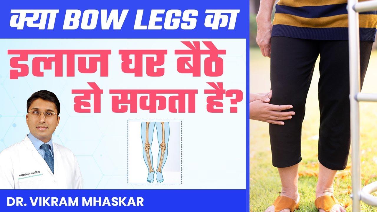क्या Bow Legs का इलाज घर बैठे हो सकता है? | Treatment Options for Bow ...