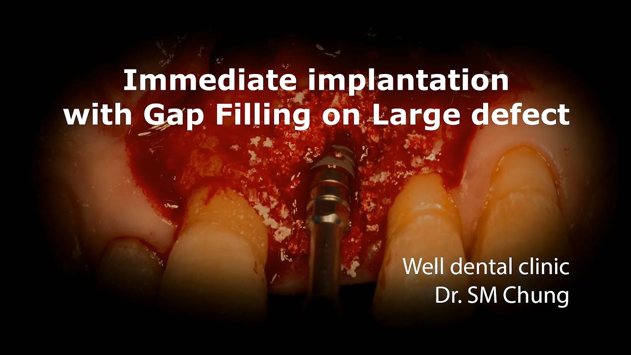 Immediate implantation with Gap Filling on Large defect (Bone Level ...