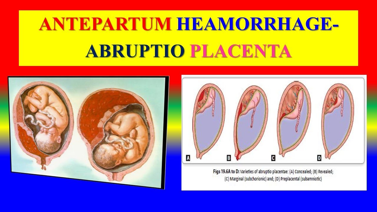 Abruptio Placentae Types