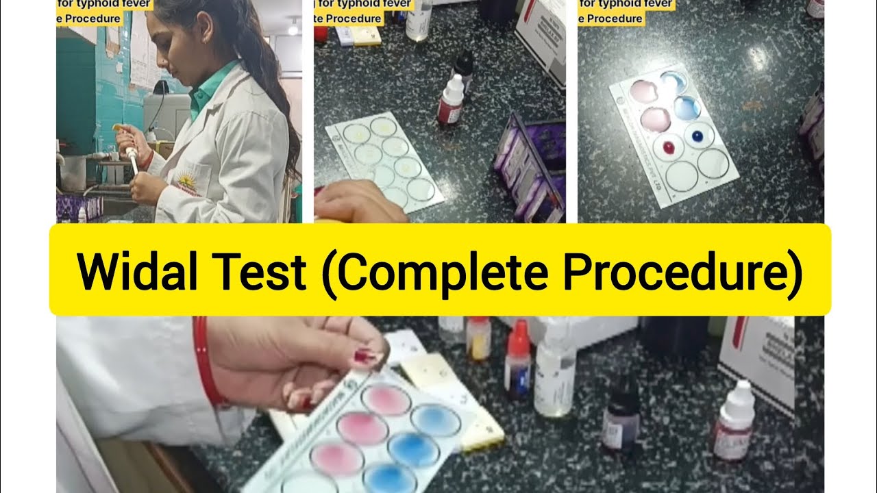 WIDAL TEST PROCEDURE - YouTube