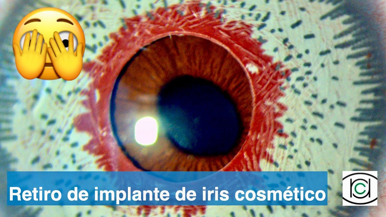 Retiro de implante de iris, Bright Ocular Iris Implant - YouTube