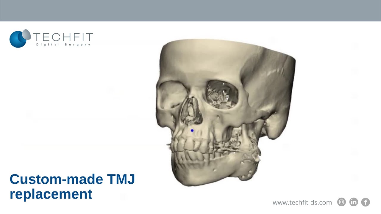 Patient-Specific TMJ solution - Techfit Digital Surgery - YouTube