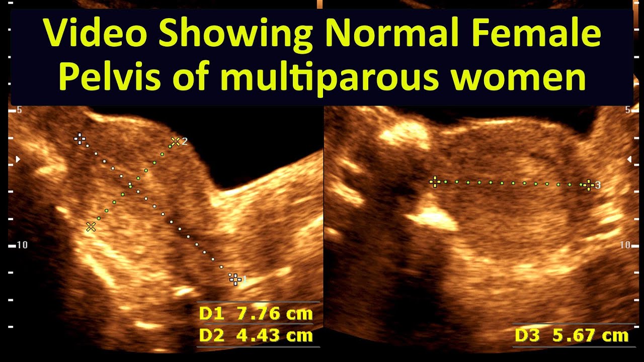Ultrasound cases 44 of 2000 - Video Showing Normal Female Pelvis of ...