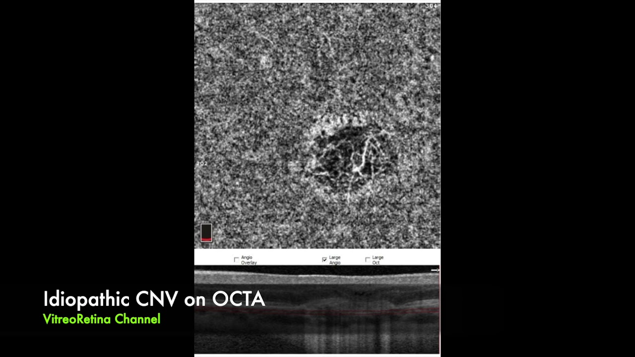 Idiopathic CNV on OCTA - YouTube