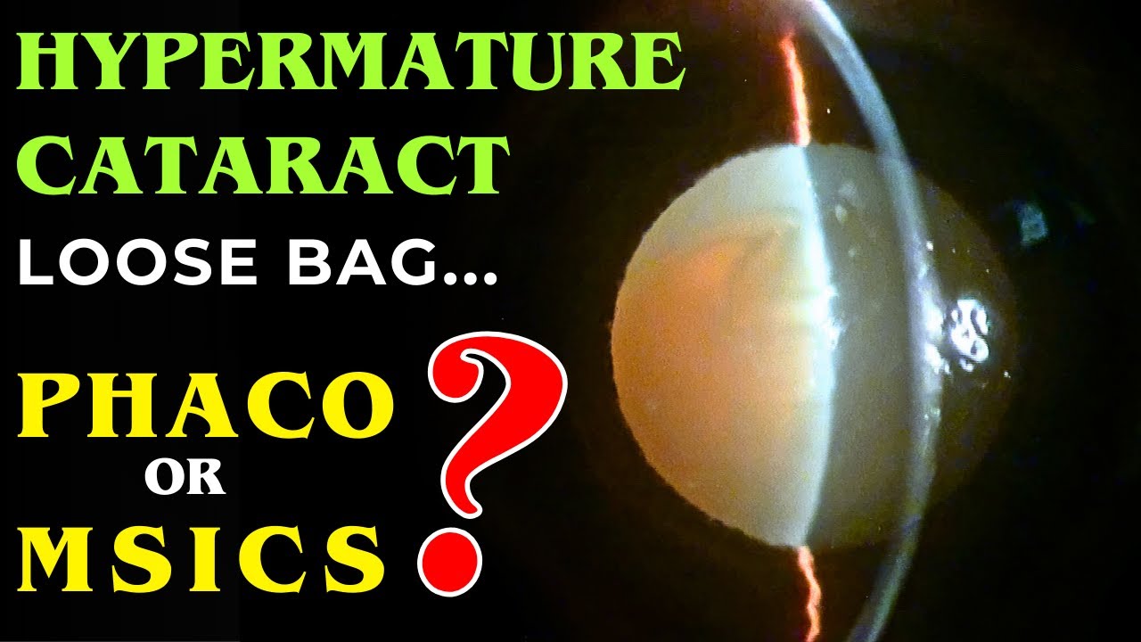 Morgagnian cataract & Loose bag (LIG) -Phaco or MSICS ..? - Dr. Deepak ...