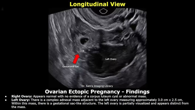 Cranial Ectopic Pregnancy