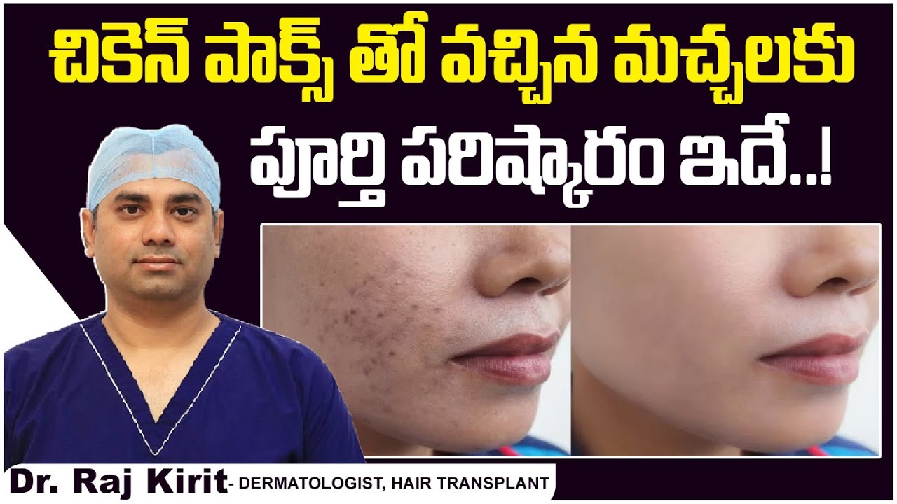 చికెన్ పాక్స్ మచ్చలకు || How to Remove Chicken Pox Spots from Face ...