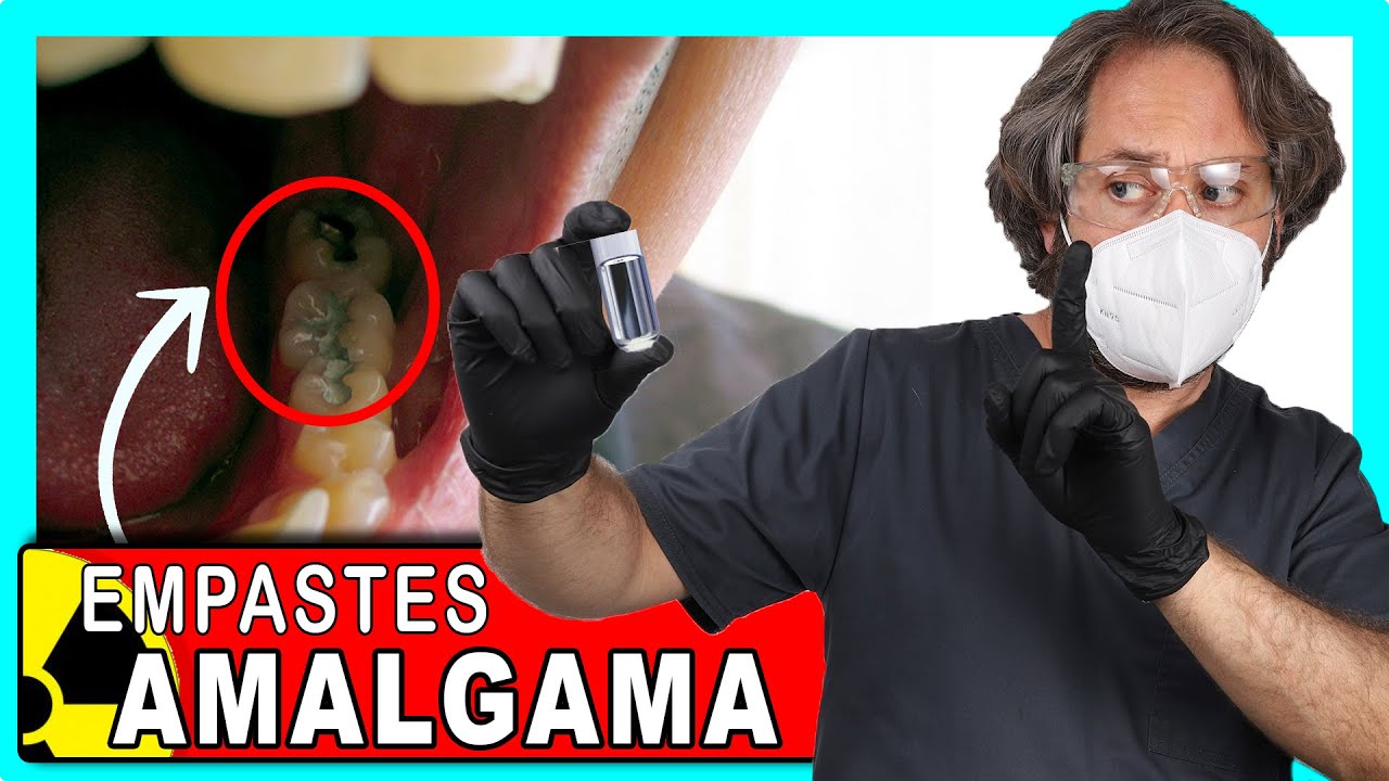 🔴EXTRACCIÓN de los EMPASTES de 𝗔𝗠𝗔𝗟𝗚𝗔𝗠𝗔 por Resinas de 𝐂𝐎𝐌𝐏𝐎𝐒𝐈𝐓𝐄 ...