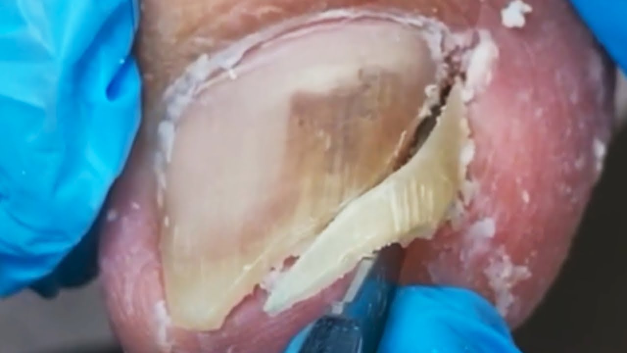 Cut Off The Super Large Ingrown Toenail And A Lot Of Dead Skin!【Crazy ...