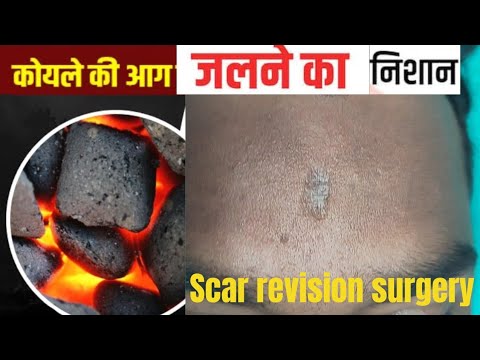 Scar on Forehead| Scar revision surgery for forehead scar | Scar ...