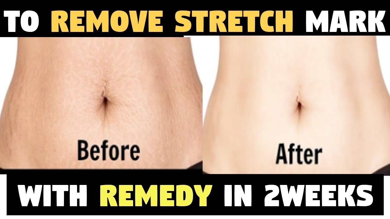 We Show You HOW TO REMOVE STRETCH MARKS With This Remedy in 2 Weeks ...