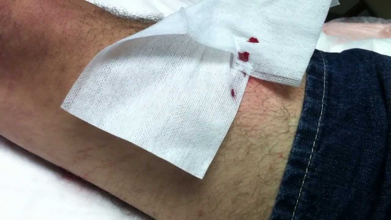 Jesse's Surgery on Brown Recluse Bite - YouTube