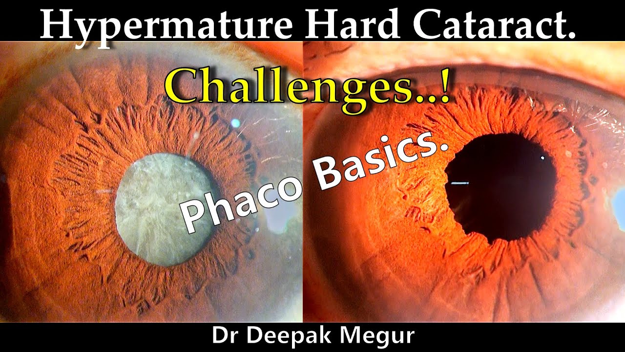 Principle to follow during Phacoemulsification in Hard Cataract - Phaco ...