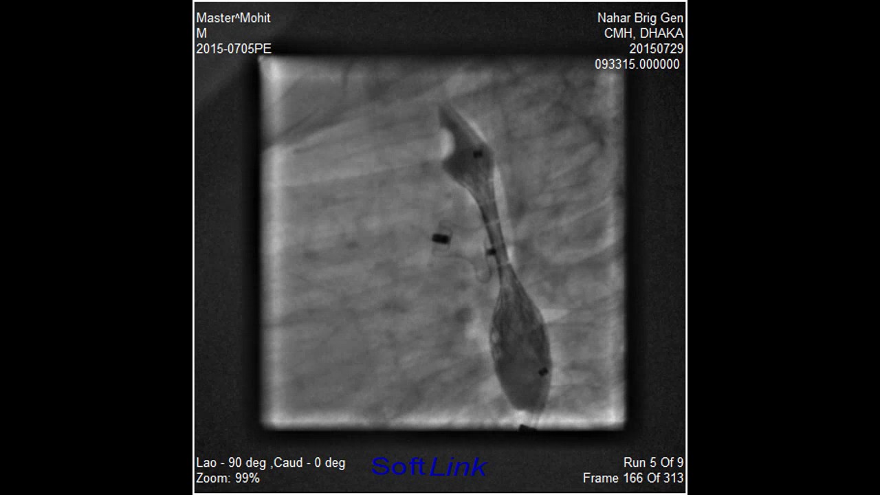 Mohit COA stent 3 - YouTube