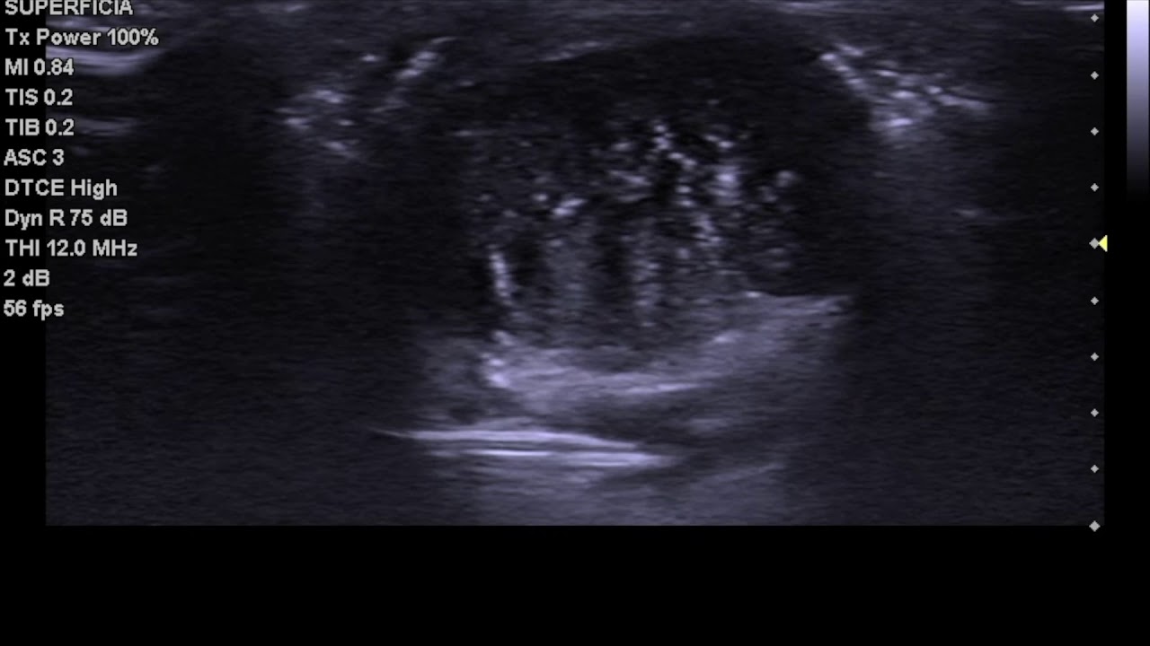 Τενοντίτιδες-High volume injection - YouTube