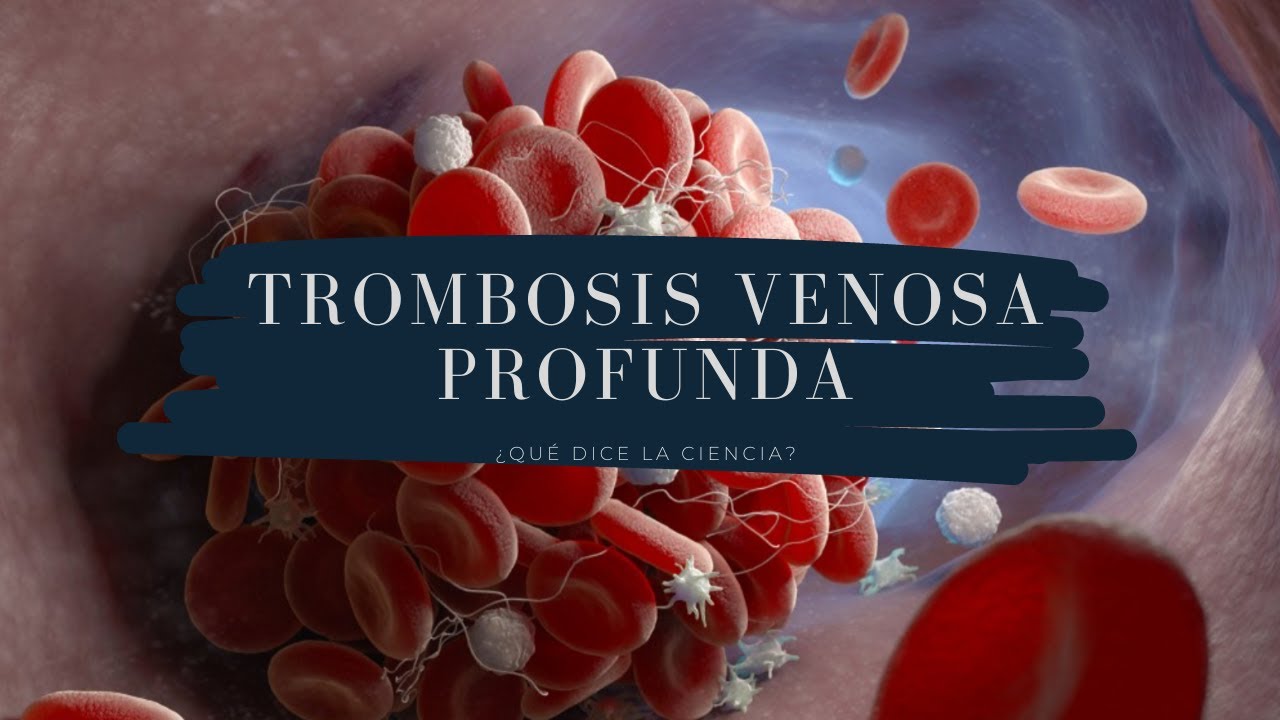 TROMBOSIS VENOSA PROFUNDA- ¿Qué es? ¿Qué síntomas provoca? ¿Cómo ...