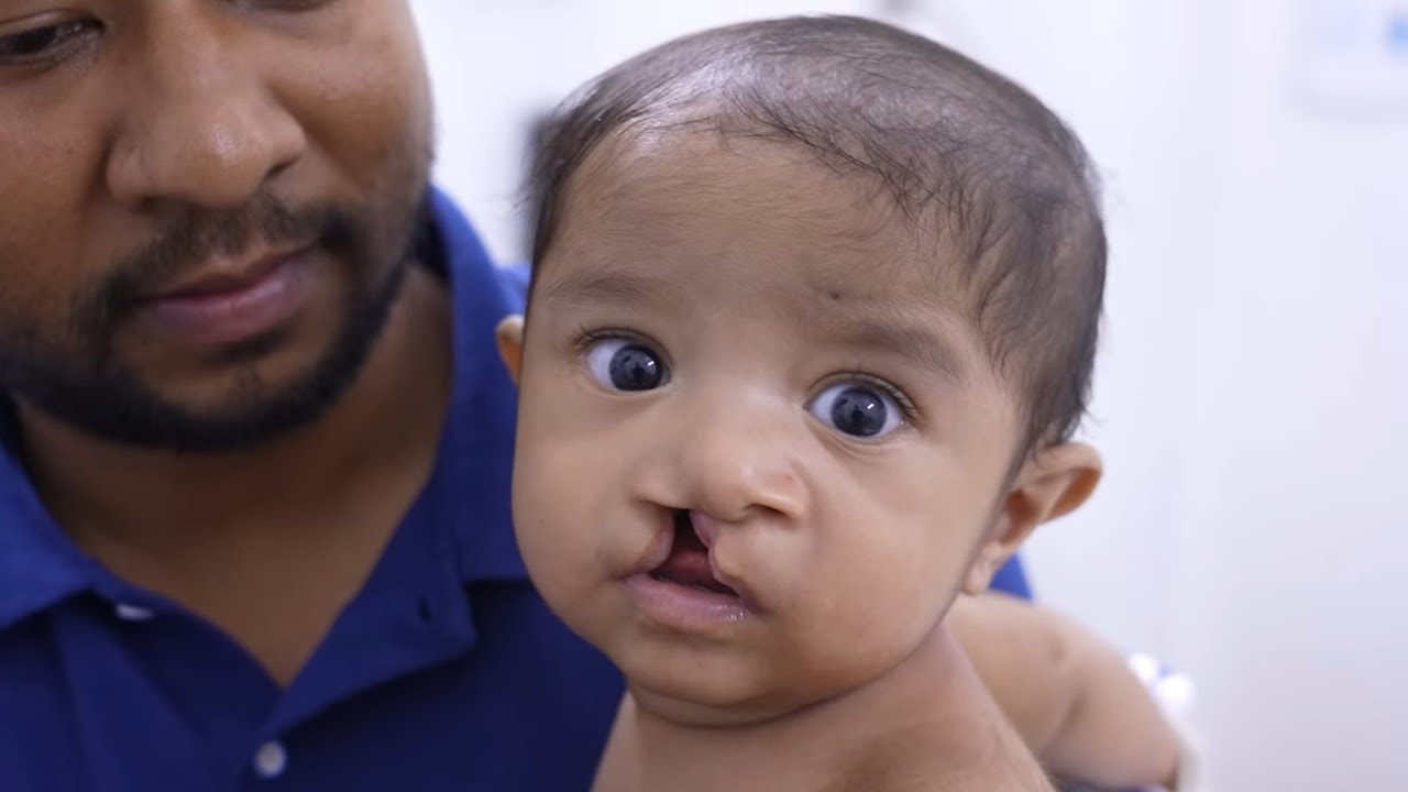 Amazing Transformation: Before and After Cleft Lip Surgery - YouTube