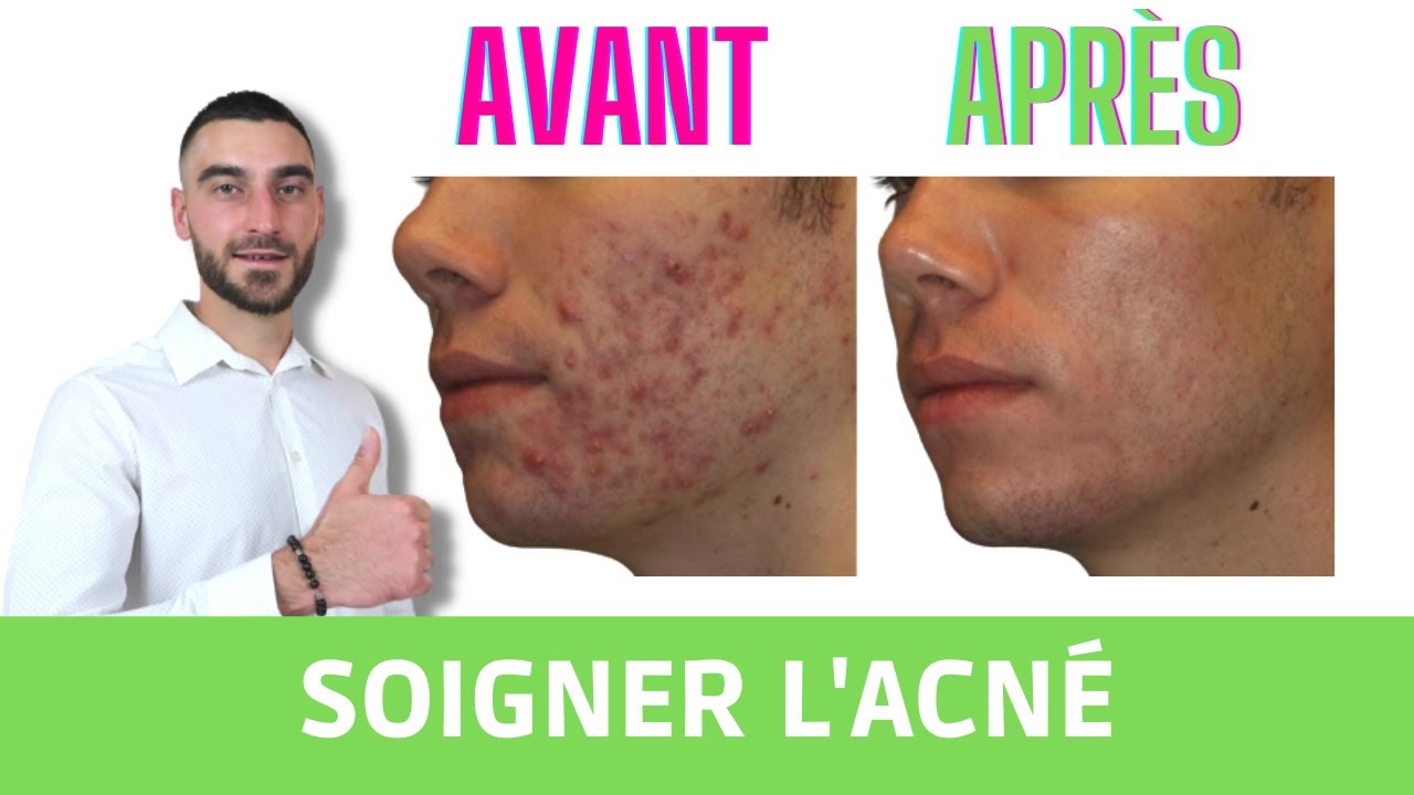 Comment soigner et traiter l'acné naturellement (remèdes naturels ...