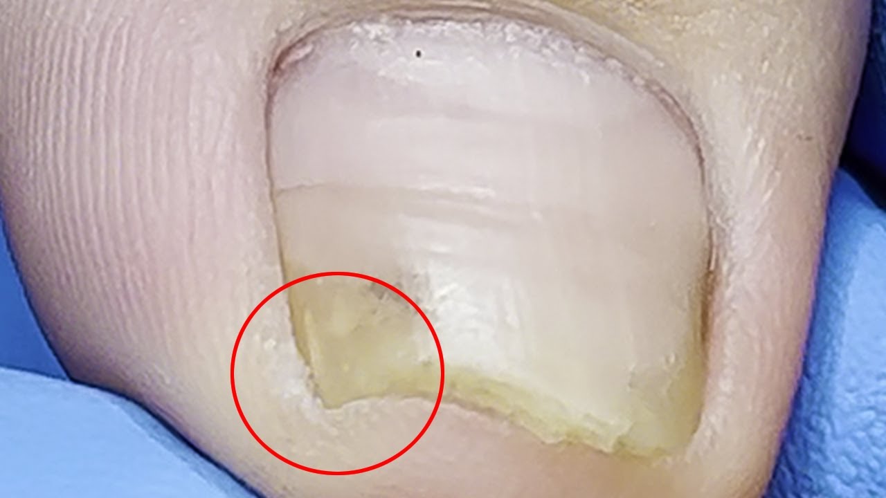 Toenails growing down! pull out the nails【Xue Yidao Pedicure】 - YouTube