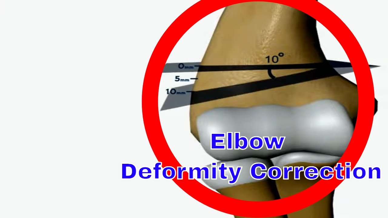 Fixing Elbow Varus Deformity 팔꿈치 내반 변형 교정하기 - YouTube