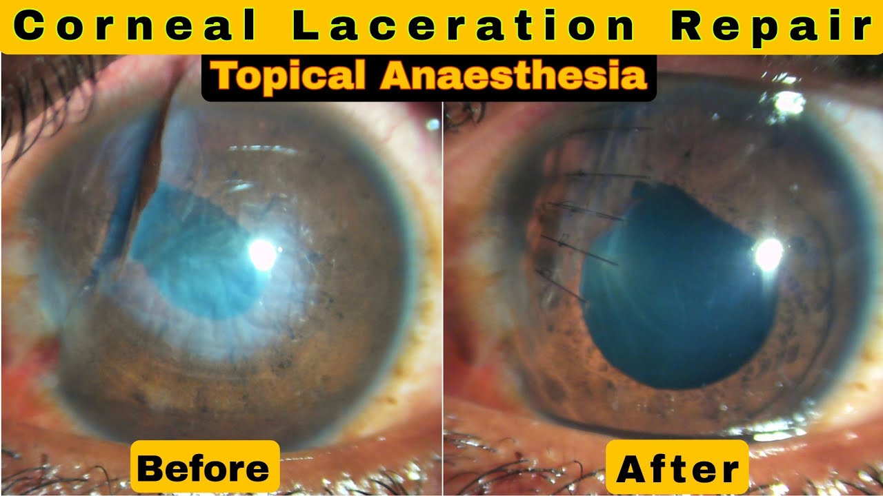 #100 Topical Corneal scleral laceration repair + AC reconstruction ...