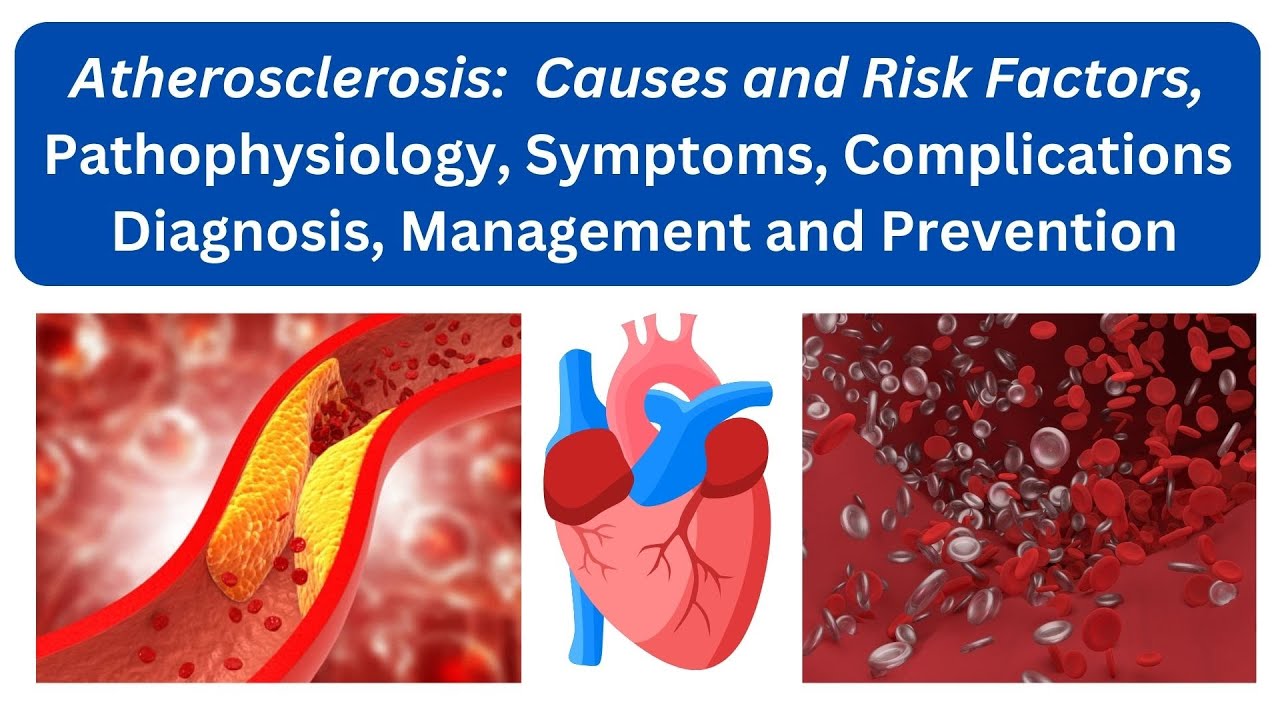 Atherosclerosis - Causes, Symptoms, Types, Diagnosis, Complication ...