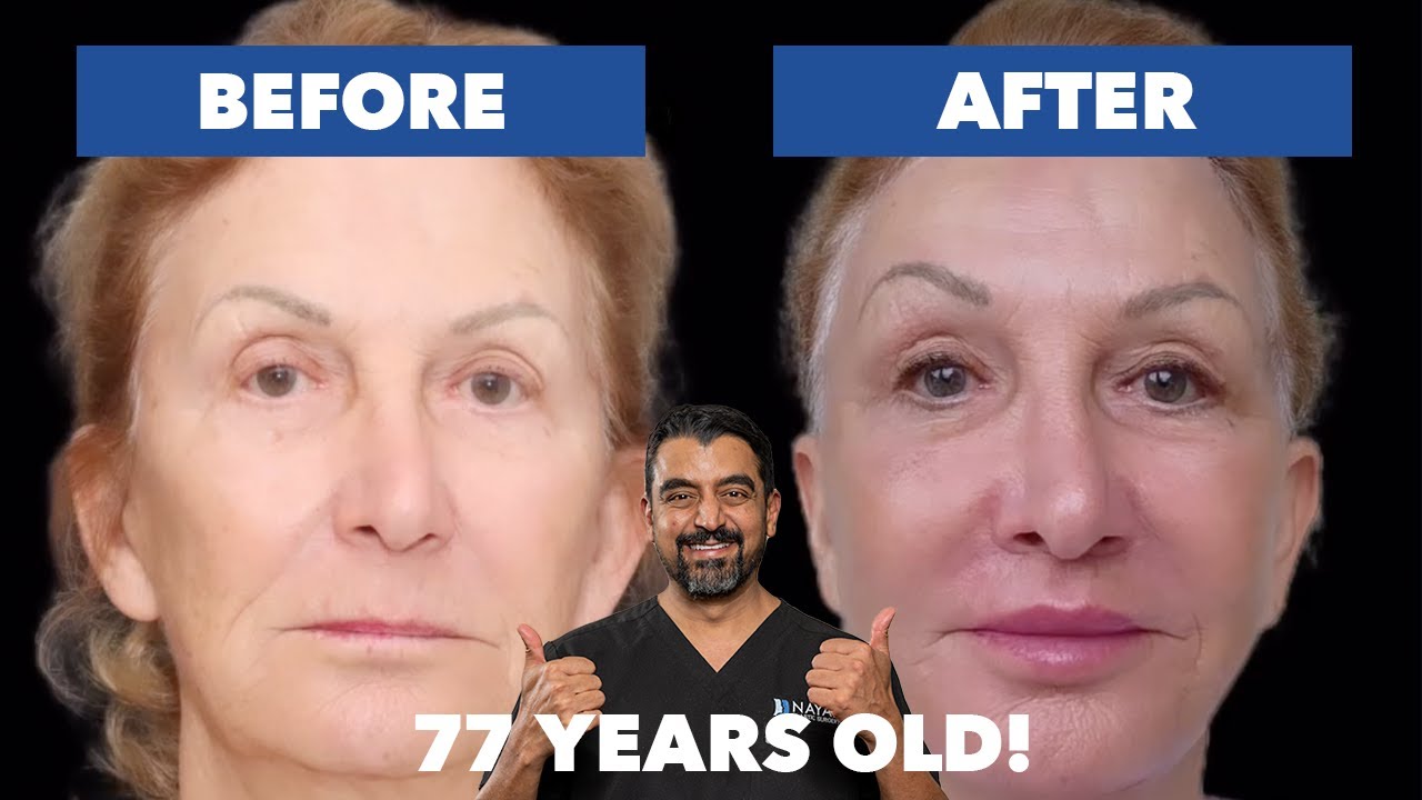 77 Year Old Facelift with AMAZING Results - YouTube