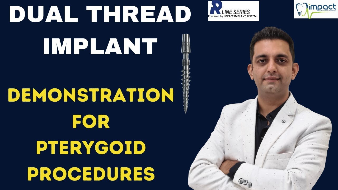 🔥 “Dual Thread Implant DEMO | Next-Gen Pterygoid Technique 🦷” - YouTube