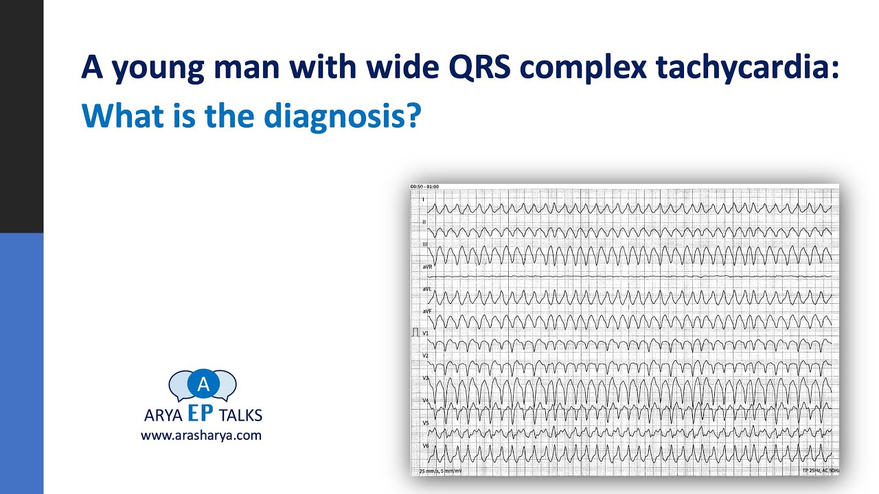Wide Qrs Complex Tachycardia