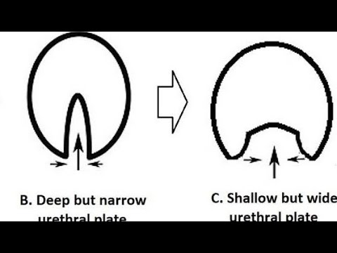 Urethral Plate Glans anatomy in hypospadias repair @Pediatric-Urologist ...