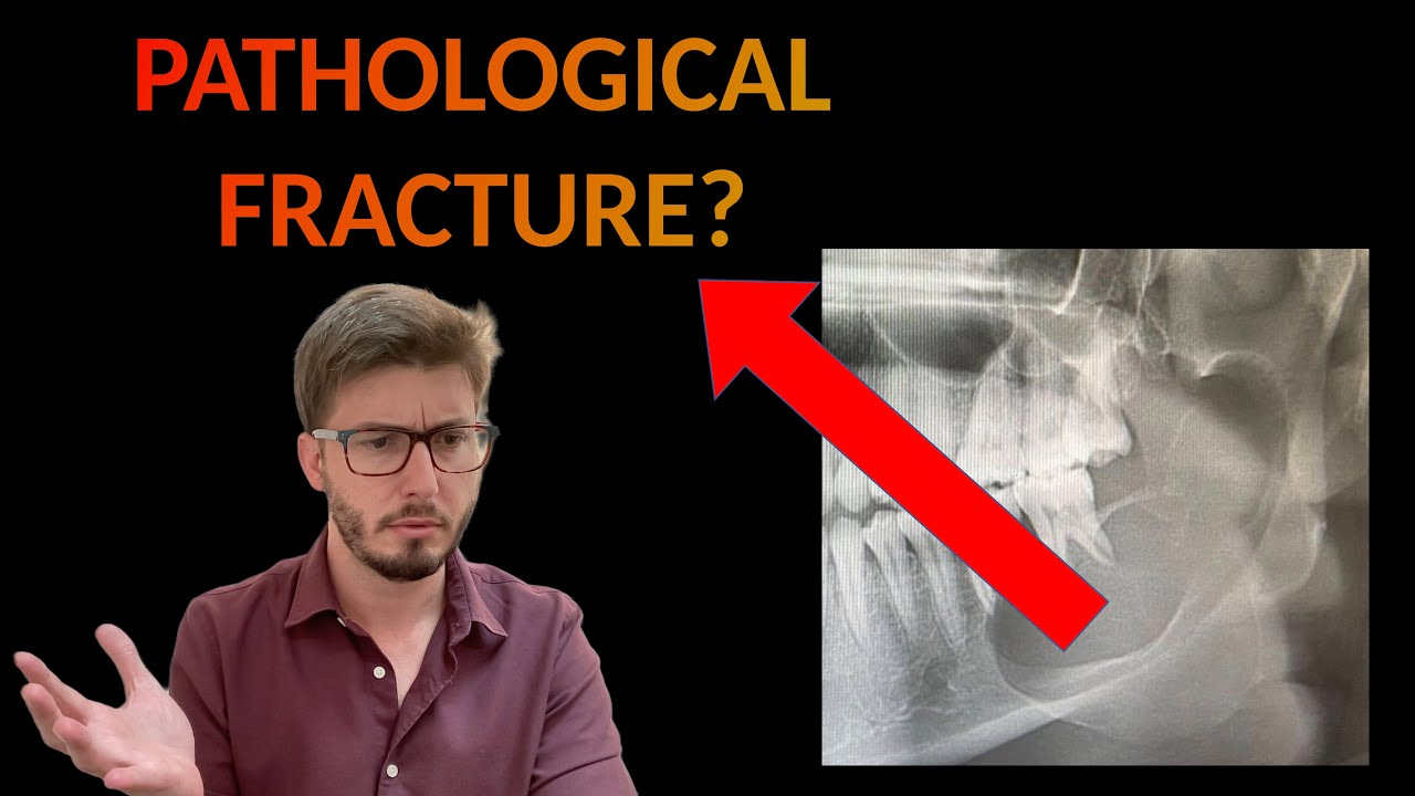 Marsupialization Fully EXPLAINED: Oral Surgery Tutorial (Cases of ...