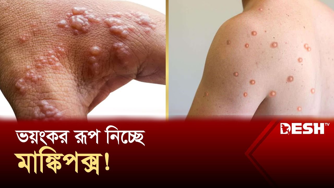 সংক্রমণ দ্রুত ঠেকানোর তাগিদ বিশেষজ্ঞদের | Monkey Pox | News | Desh TV - YouTube