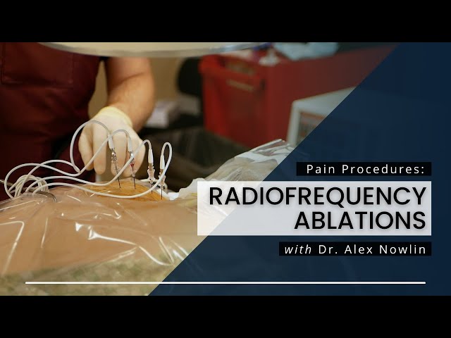 Rf Ablation Side Effects