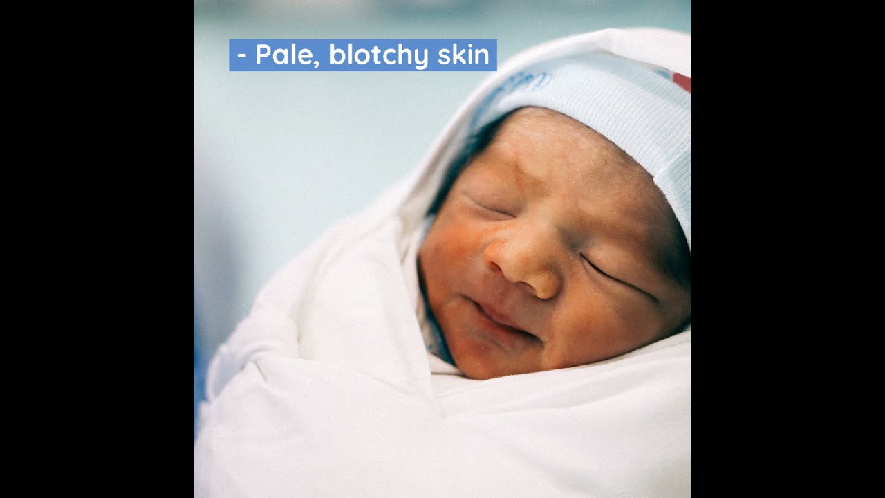 Neonatal Group B Strep Rash