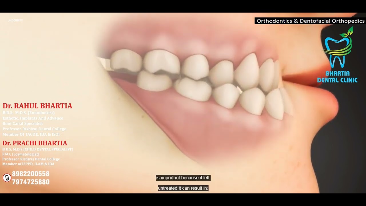 UNDER BITE ( ORTHODONTICS ) - YouTube
