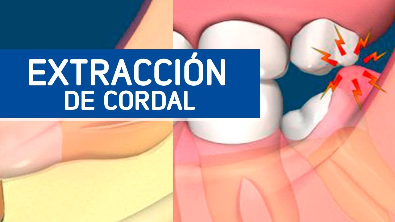Extracción muela del juicio / Odontoespecialistas - YouTube
