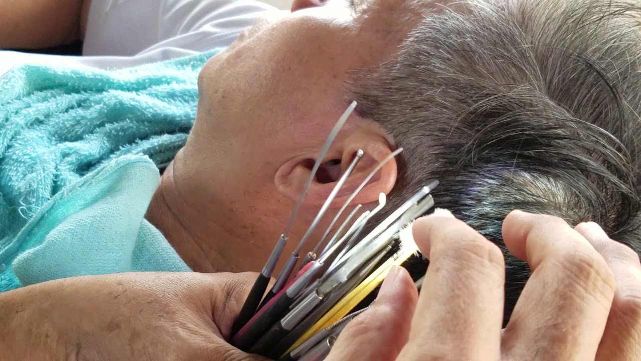 60 YEAR OLD MAN HAPPY WITH EARWAX AND EARWAX REMOVAL ZOOMING -SAI GON ...