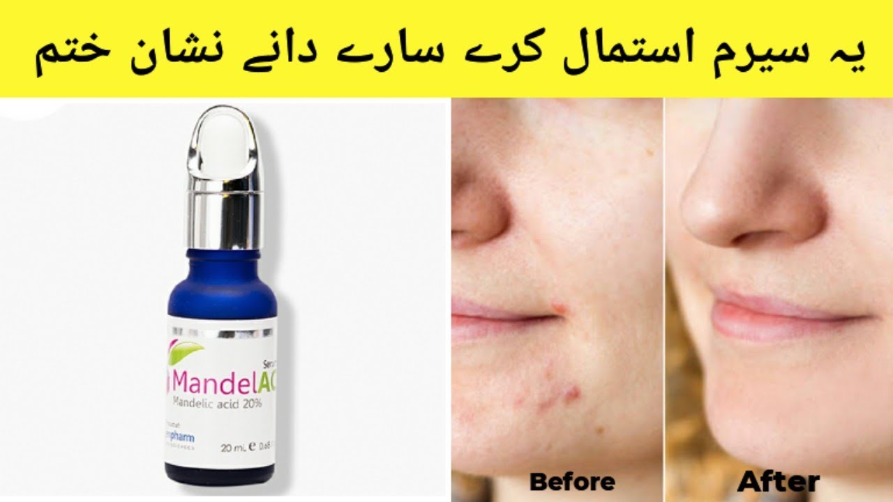 Jenpharm mandel AC serum review | anti acne | in urdu | hindi ...