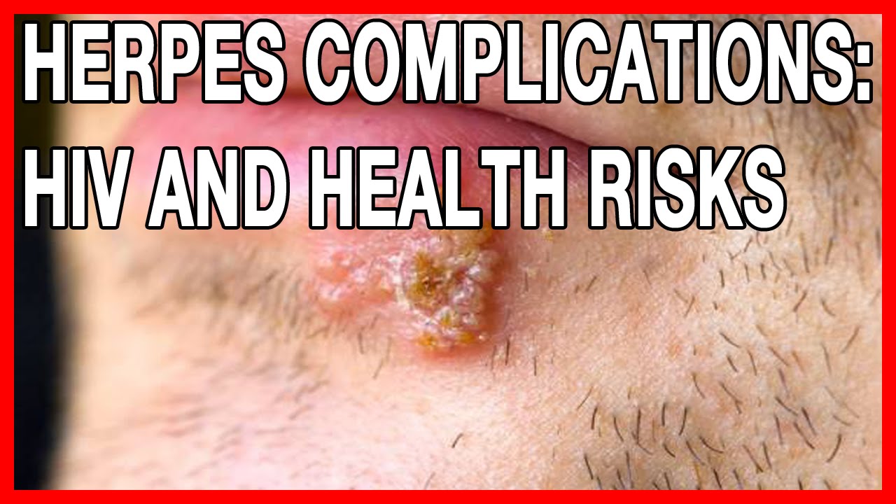 STDs: Herpes Complications, HIV and Health Risks - YouTube