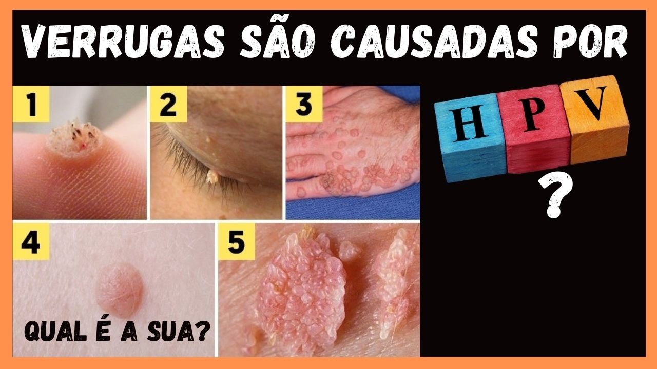 Como Surgem as Verrugas? Verrugas HPV. Verrugas Pelo Corpo, no Pescoço ...