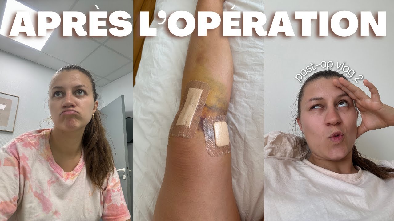 COMMENT JE SURVIS APRÈS L'OPÉRATION | Post op vlog n°2 : kiné ...