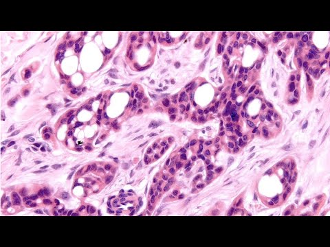 Primary cutaneous cribriform carcinoma McKee - YouTube
