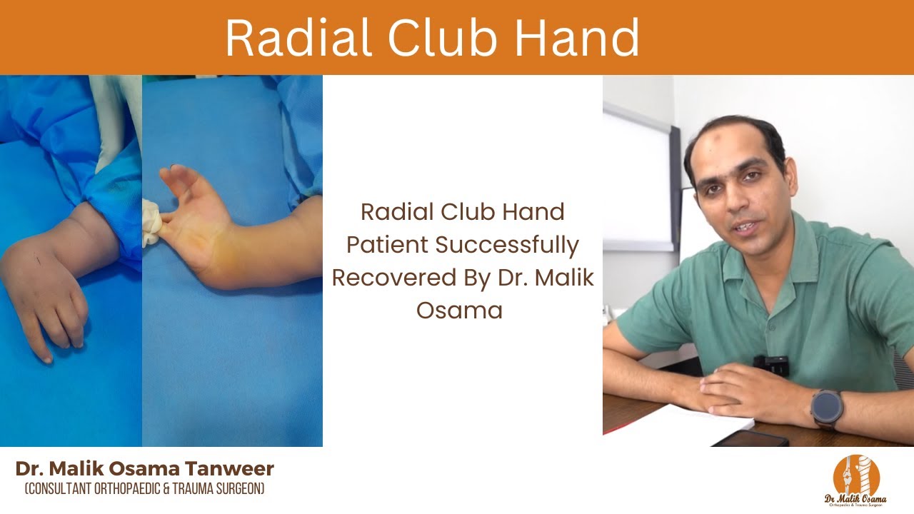 Radial Club Hand Patient Successfully Recovered By Dr. Malik Osama ...